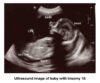Trisomy 18- Definition, Symptoms, Pictures, Diagnosis And Life Expectancy
