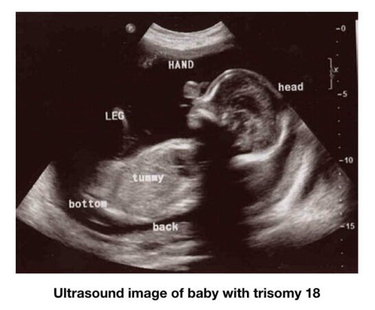 Trisomy 18- Definition, Symptoms, Pictures, Diagnosis And Life Expectancy