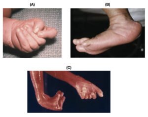 Trisomy 18- Definition, Symptoms, Pictures, Diagnosis And Life Expectancy