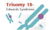 Trisomy 18- Definition, Symptoms, Pictures, Diagnosis And Life Expectancy