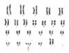 Trisomy 21 (Down Syndrome): Definition, Causes, Symptoms, Pictures and ...