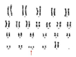 Trisomy 21 (Down Syndrome): Definition, Causes, Symptoms, Pictures and ...