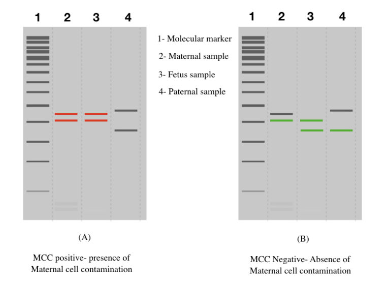 Maternal Cell Contamination In Prenatal Genetic Testing – Genetic Education